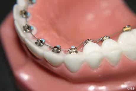 Harga Pasang Behel - Orange Dental